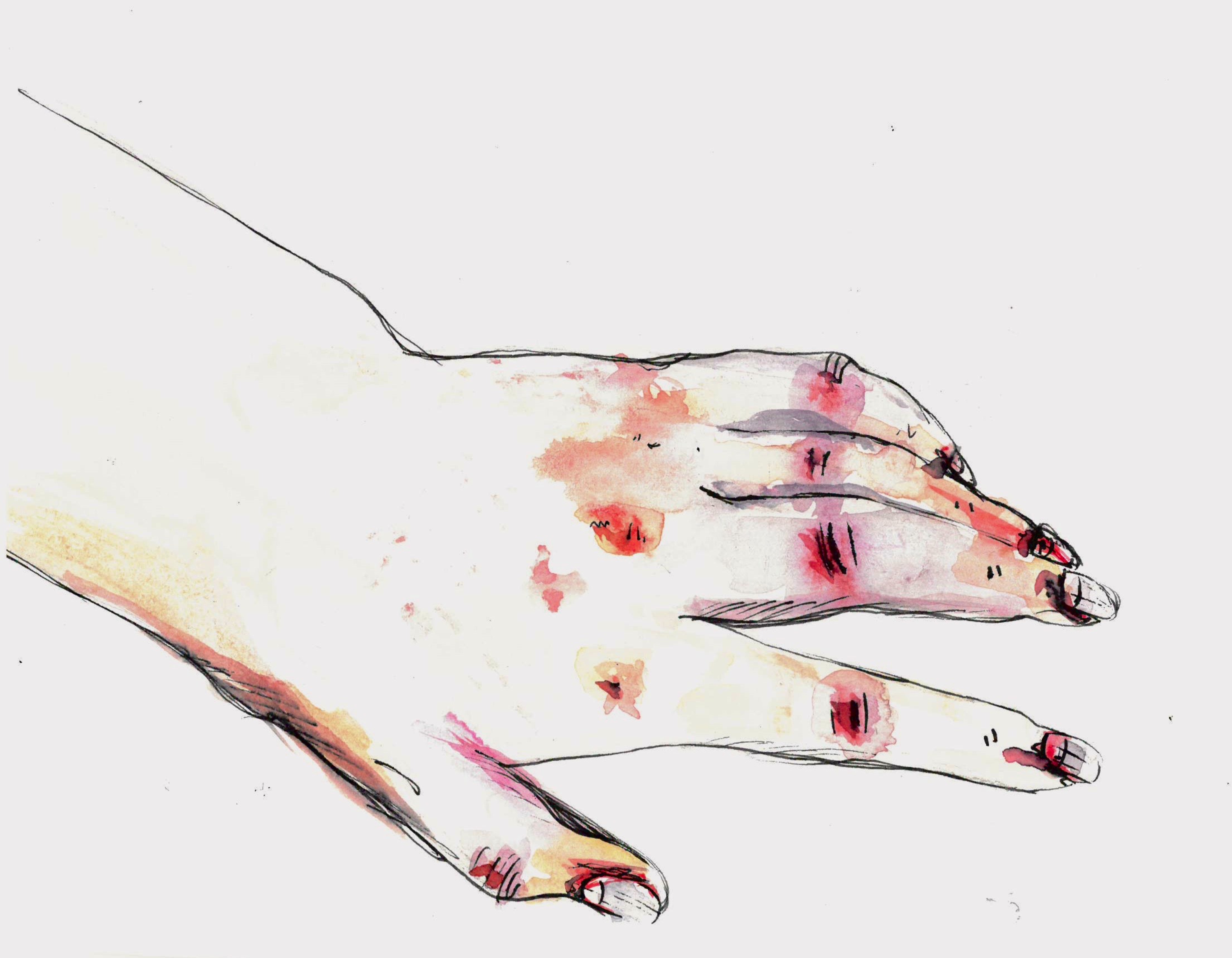 Bruised Hand Watercolour Illustration by Jen's Portfolio in Durham